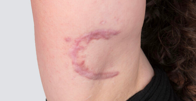 Kerry's Story - Alliance Kelo Cote