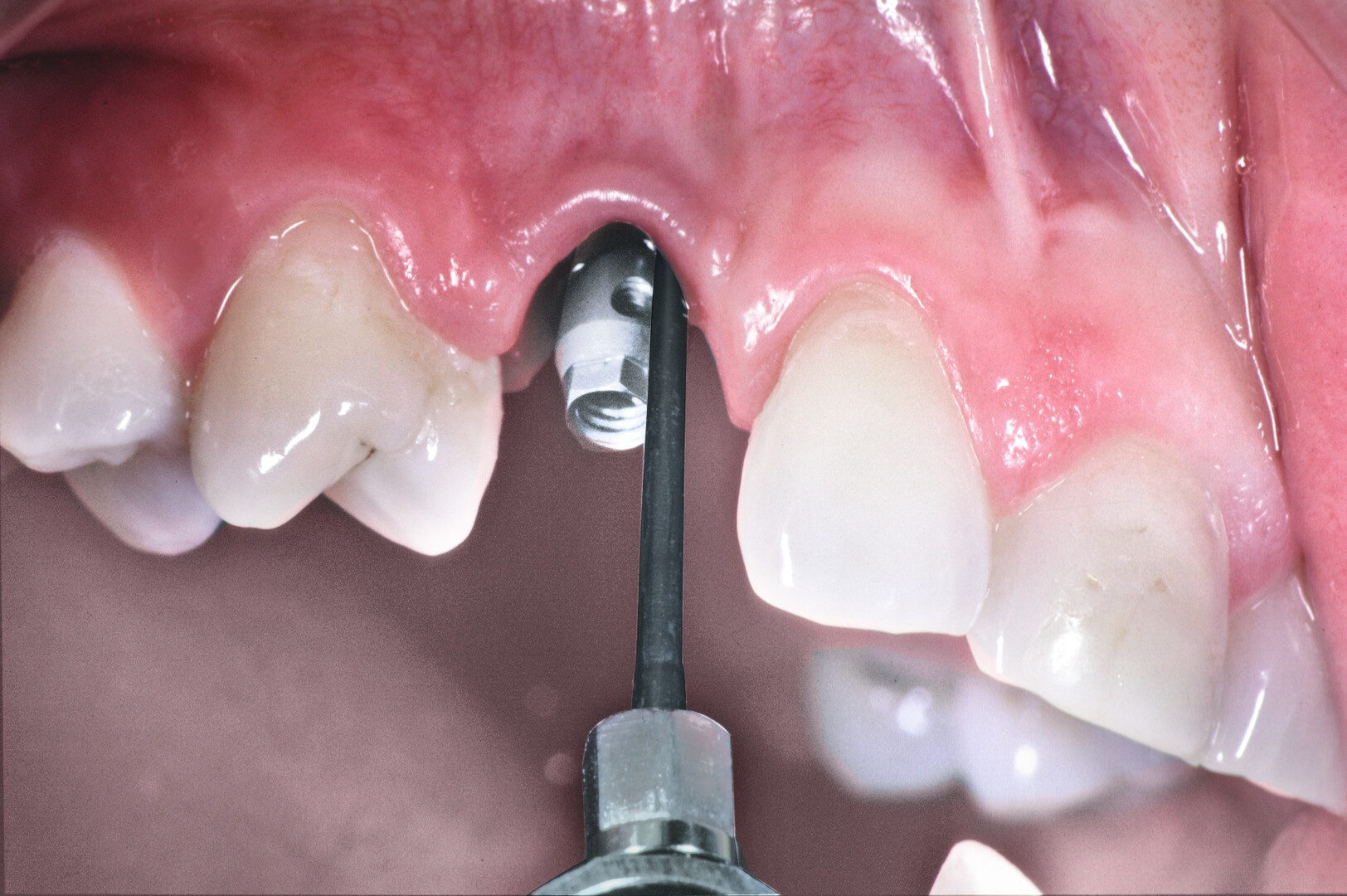 Parodontitistherapie mit Vector® Paro und Vector® Scaler | Dürr Dental ...